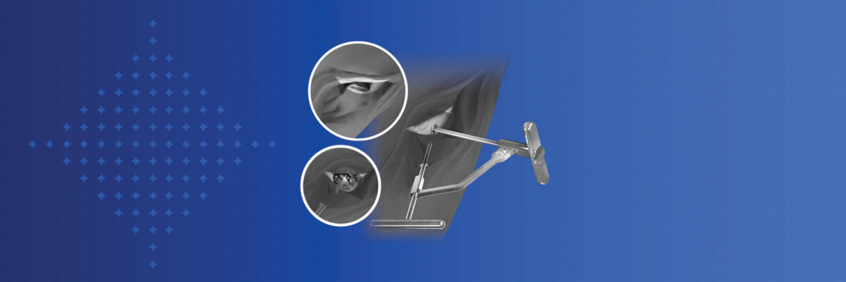 Microport Products ⋆ Joint Academy Microport